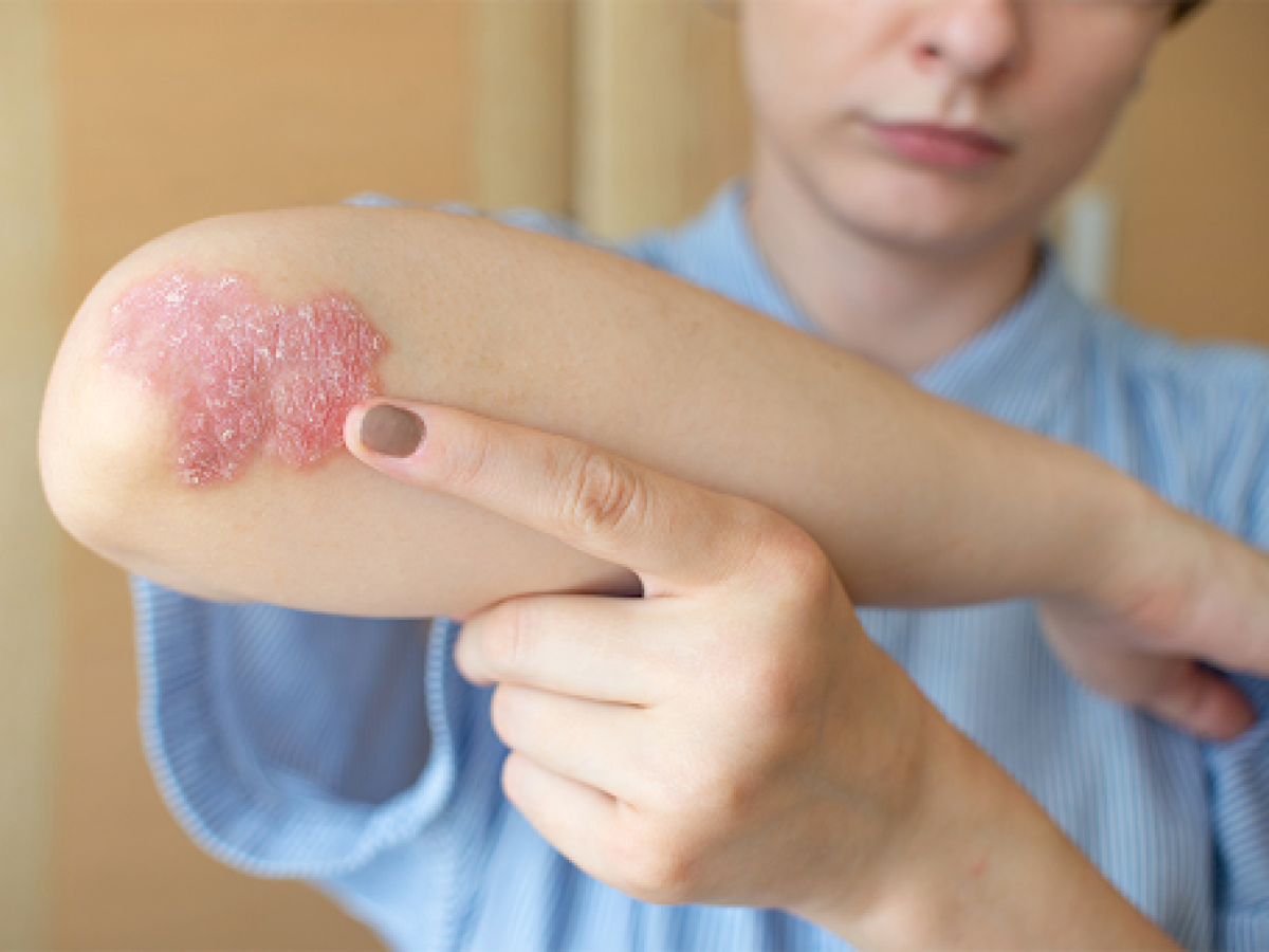 Ringworm Pictures How To Identify Ringworm On Your Body Ringworm: